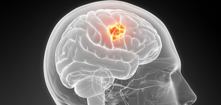 Aggressive Growth of Common Brain Tumors Linked to Single Gene - Cancer ...